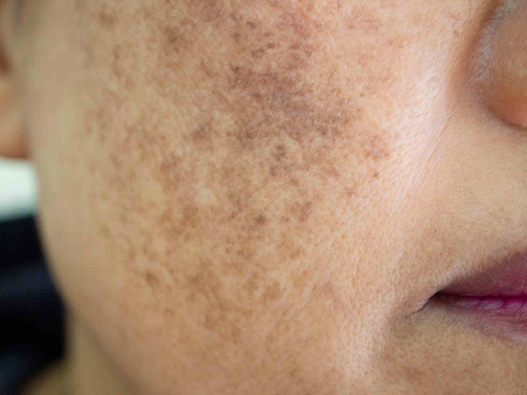 Melasma – EPF Dermatology